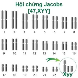 Những Điều Cần Biết Về Hội Chứng Jacobs XYY